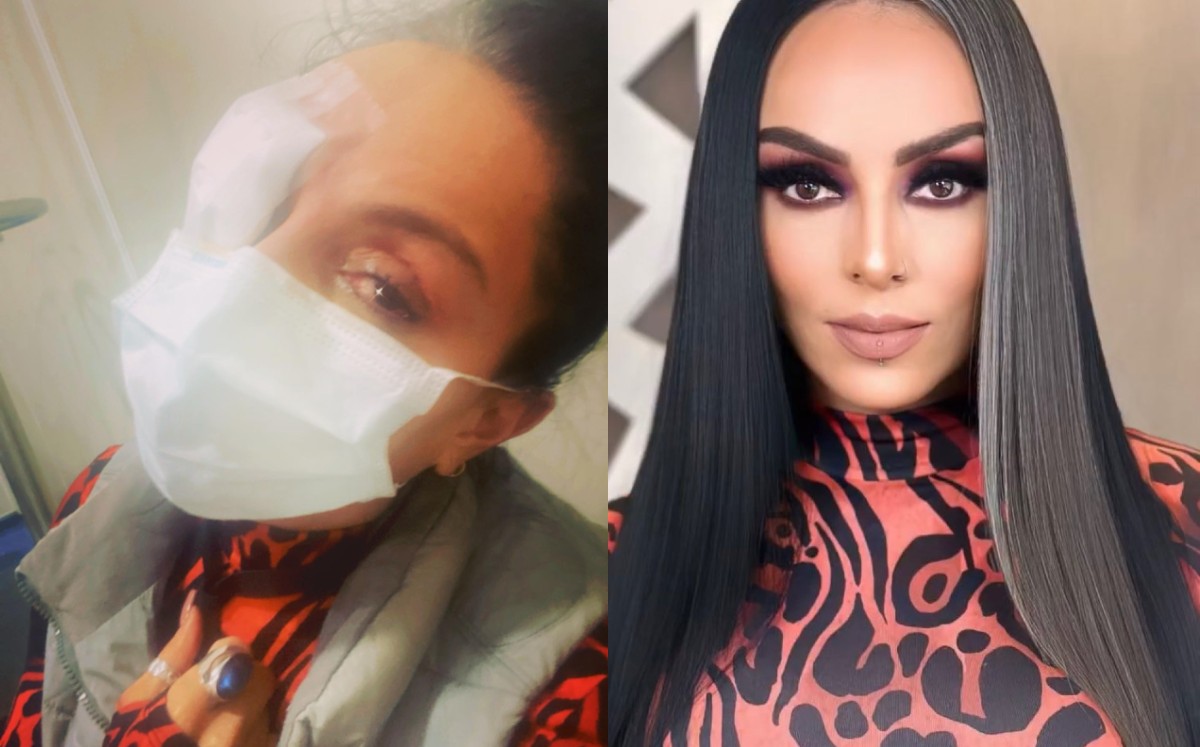 Ivonne Montero y las secuelas que tiene tras quemarse las córneas - Fama