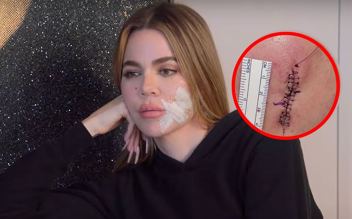 Qu Es Un Melanoma Padecimiento Que Le Detectaron A Khlo Kardashian Qu Es Un Melanoma Padecimiento Que Le Detectaron A Khlo Kardashian