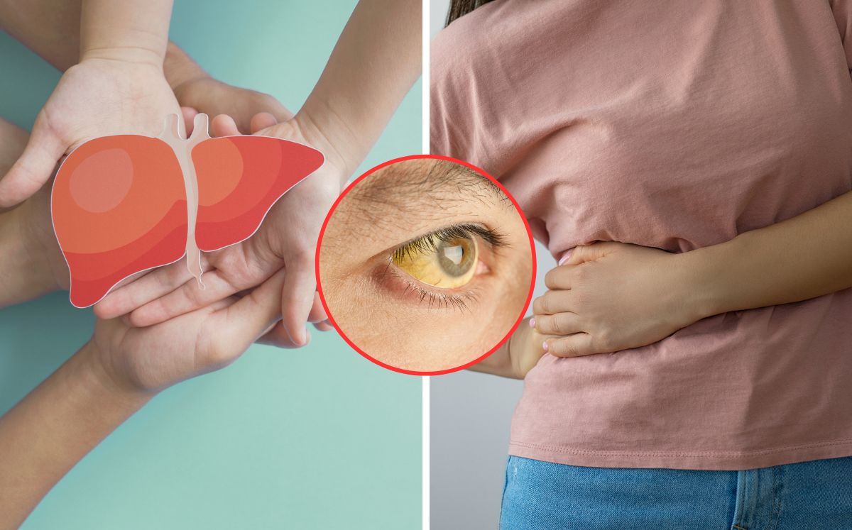Señales de hepatitis que van más allá de la piel amarila - Fama