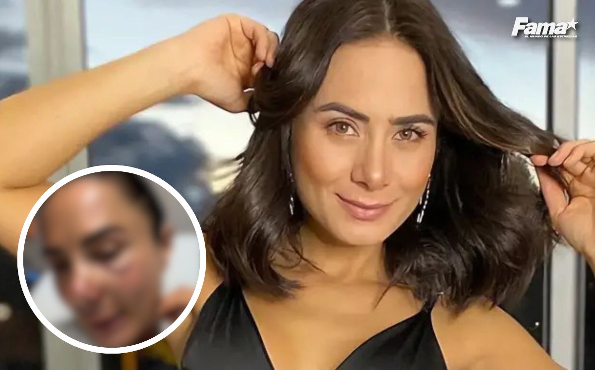 Johanna Fadul sufre desfiguración en su rostro tras grave accidente - Fama
