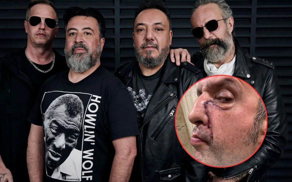 Antes y después de Tito Fuentes de Molotov tras 11 cirugíasFama
